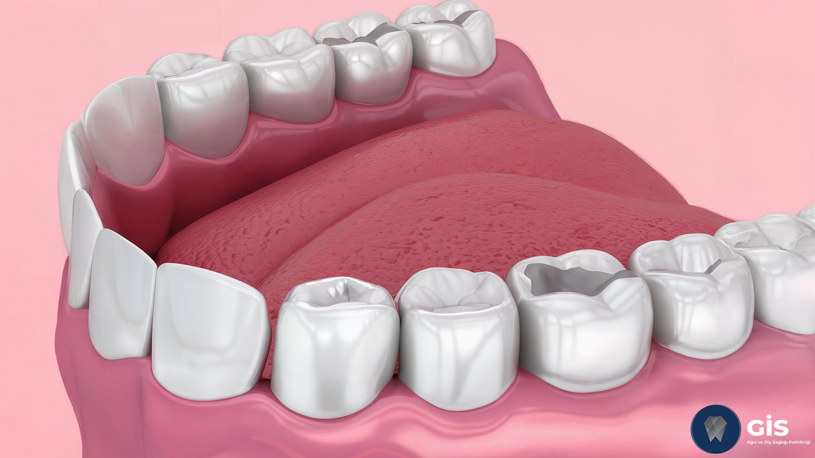 Dental Filling - Gis Dental 2026
